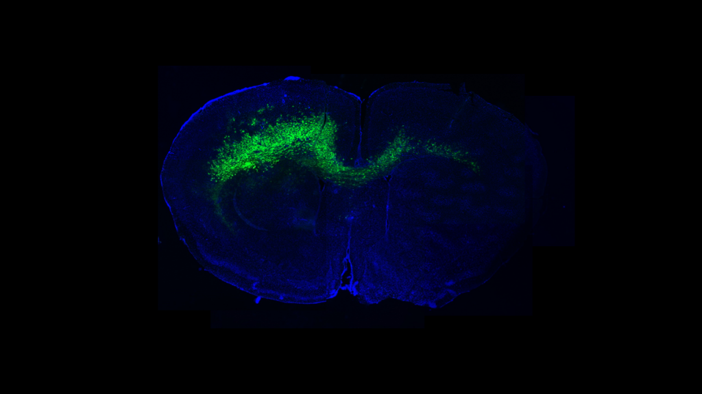 Neuron-glioblastoma conversations across the brain spark tumor invasion