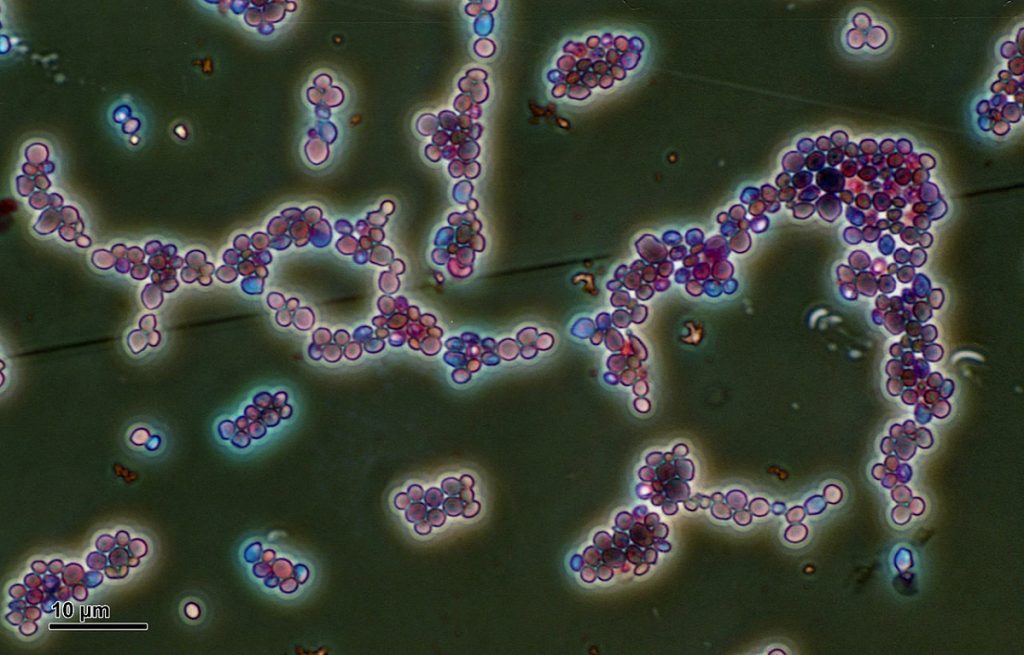 Fungal infection in the brain produces changes like those seen in ...