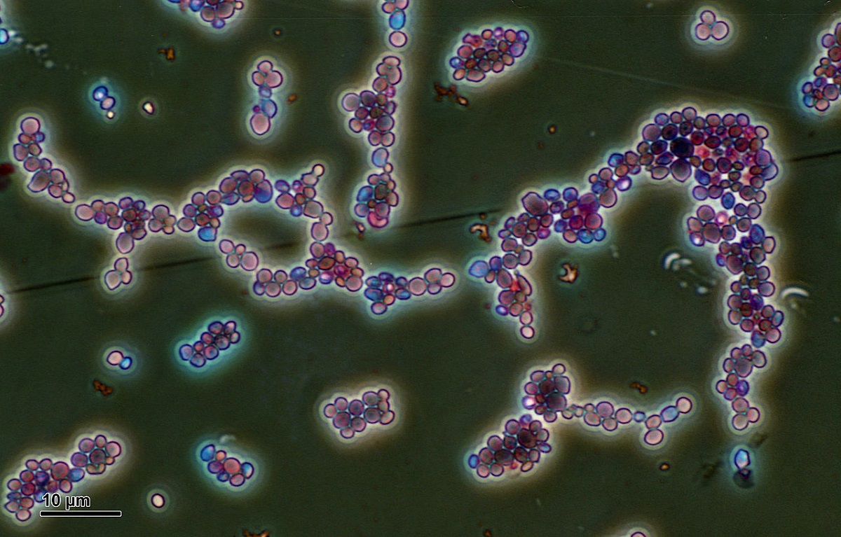 Fungal infection in the brain produces changes like those seen in ...
