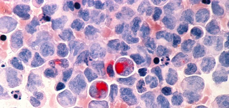Scientists uncover nuclear droplets that link multiple leukemias ...