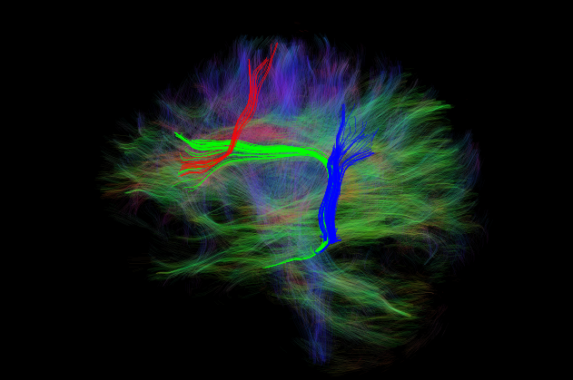 Neural tracts involved in speech recovery after stroke