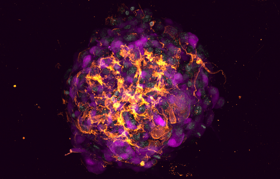 Image of the Month: Breast cancer organoid