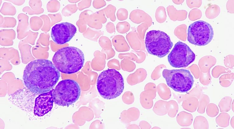 Promising approach to mitigate complications of leukemia treatment