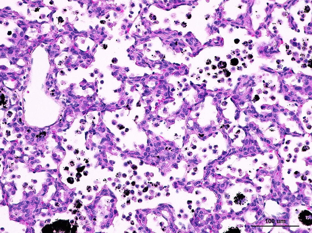 Carbon ultrafine particles accelerate lung cancer progression