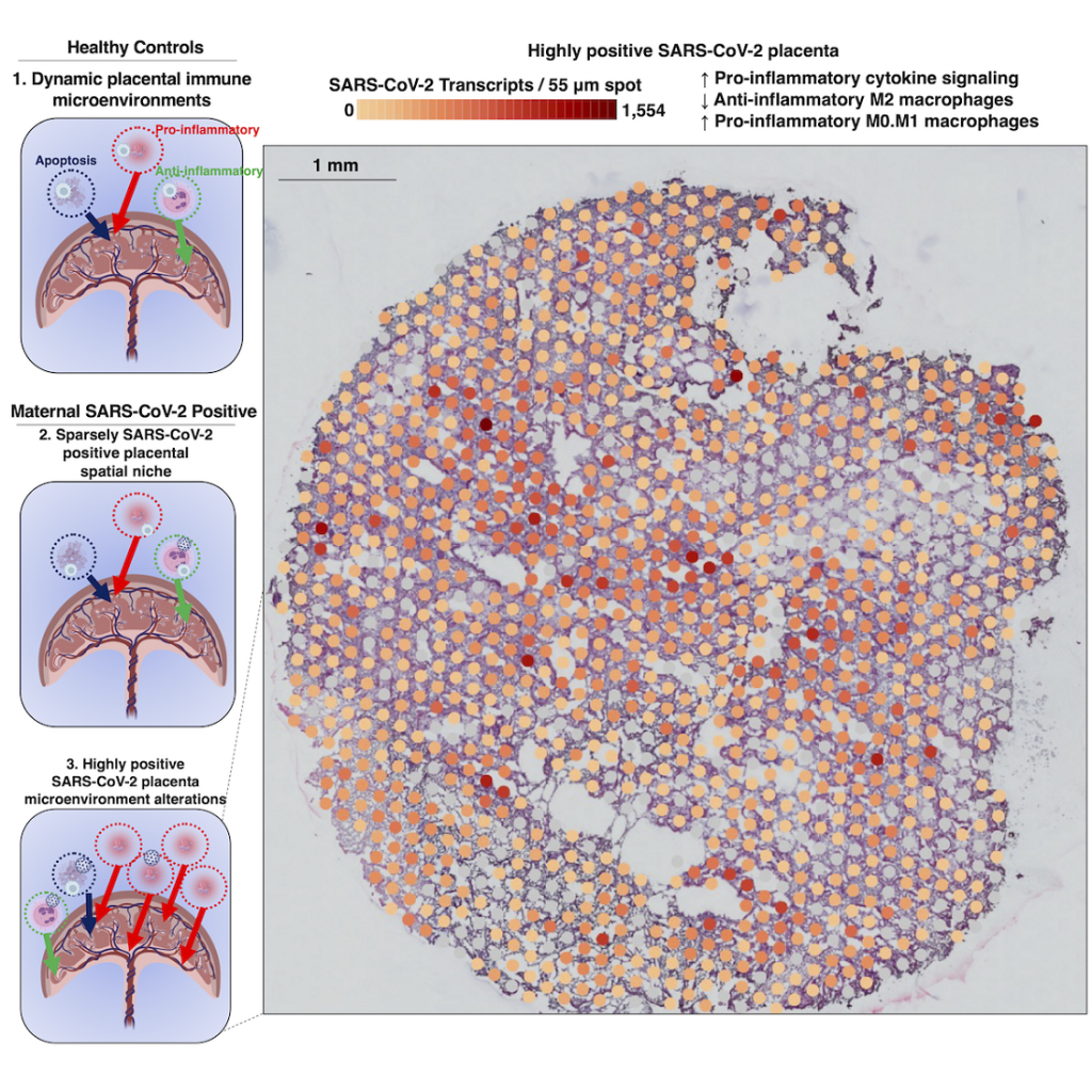 High-resolution map of the human placenta reveals COVID virus hideouts