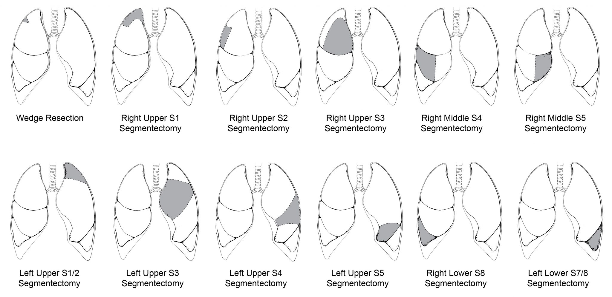 What is pulmonary segmentectomy? - Baylor College of Medicine Blog Network