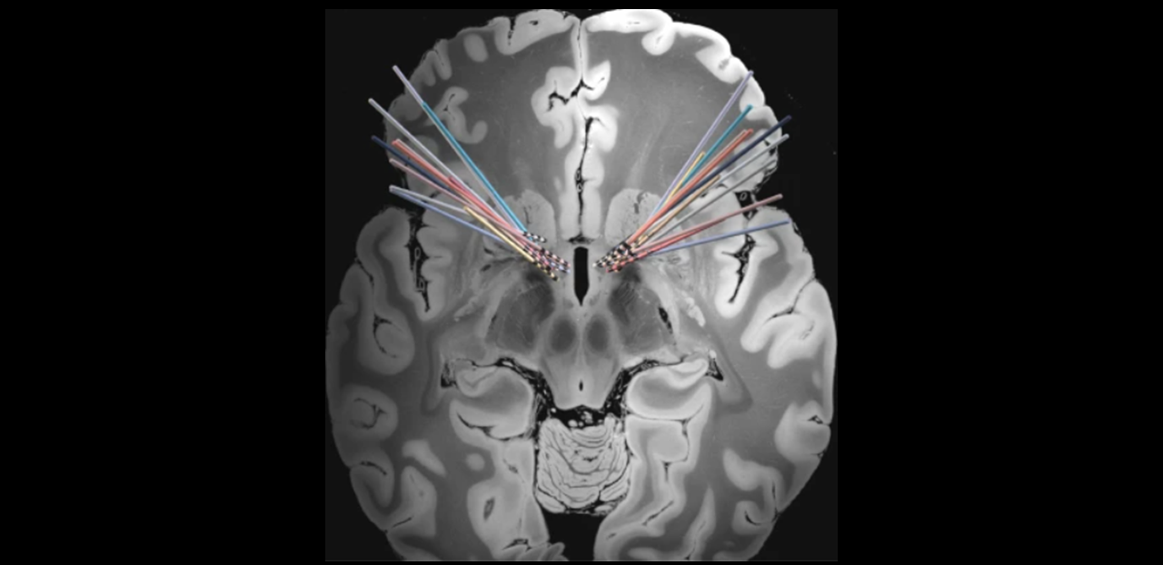 Neural biomarker to monitor OCD patient’s response to DBS