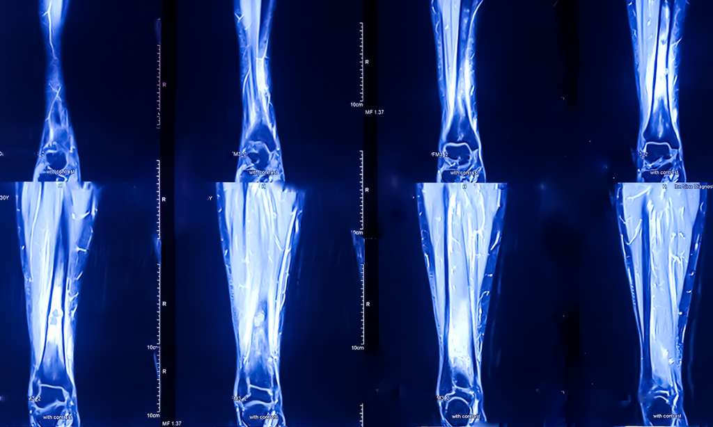 What is fracture-related infection? Causes, symptoms and treatment ...