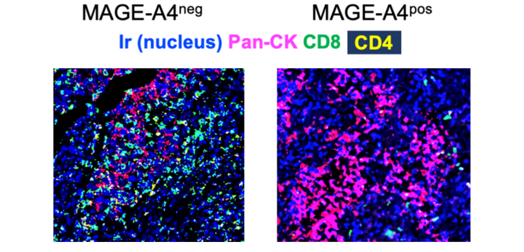 How MAGE-A4 helps tumors evade immune responses crucial for their ...
