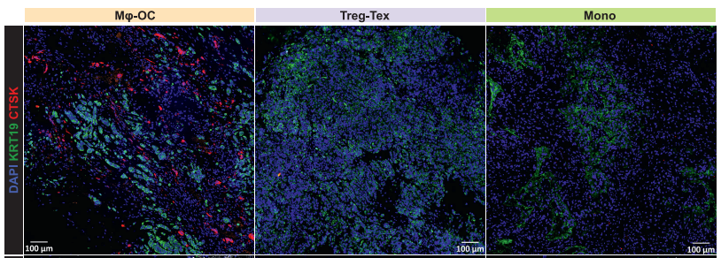 Study reveals heterogeneity of bone metastases across different and ...