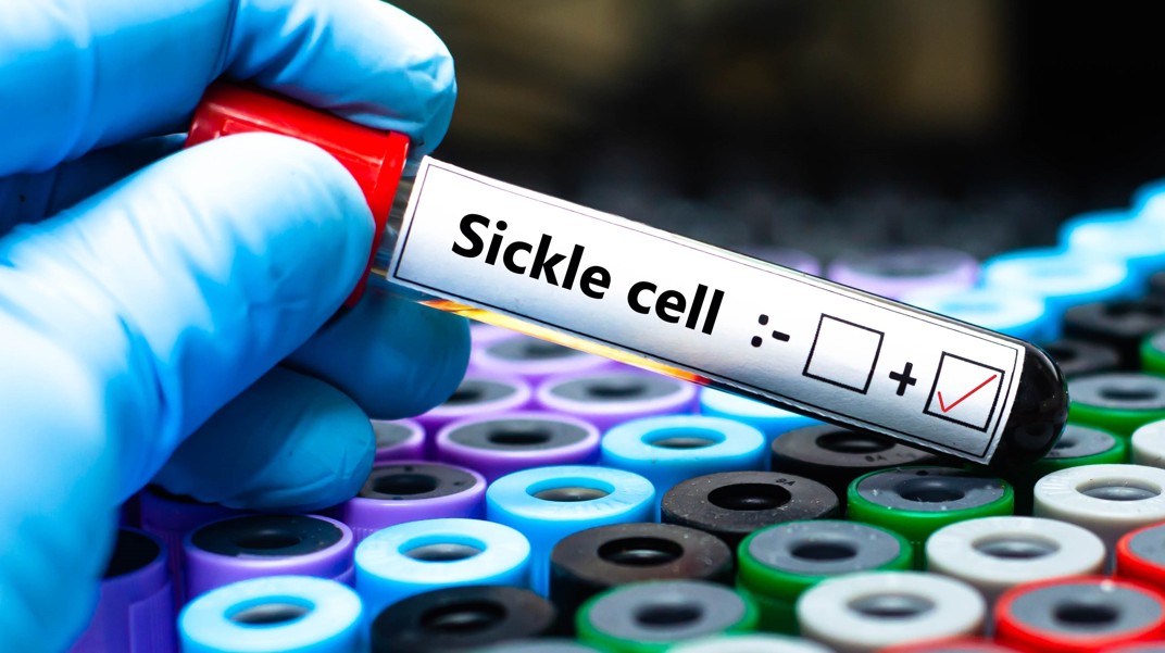 A closer look at sickle cell disease and policy - Baylor College of ...