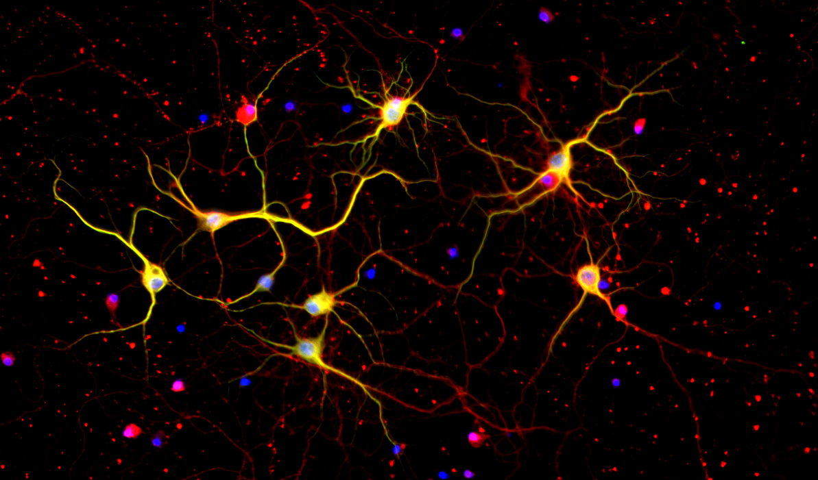 Neurons in a Huntington's brain
